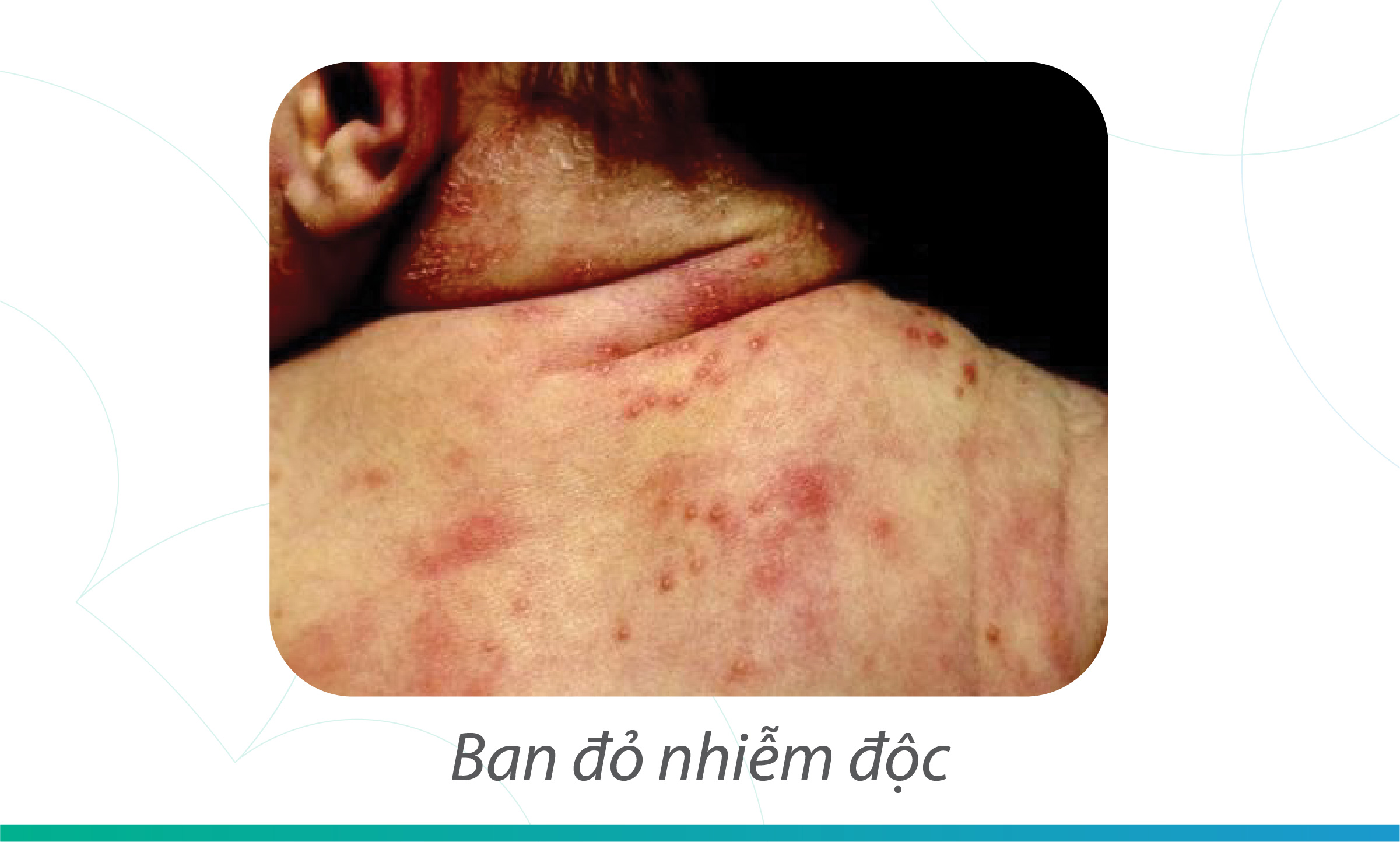 Các sang thương da thường gặp ở trẻ sơ sinh & trẻ nhỏ - Hong Hung Hospital